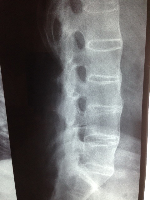 “Columna en Caña de Bambú”: Espondilitis Anquilosante ...